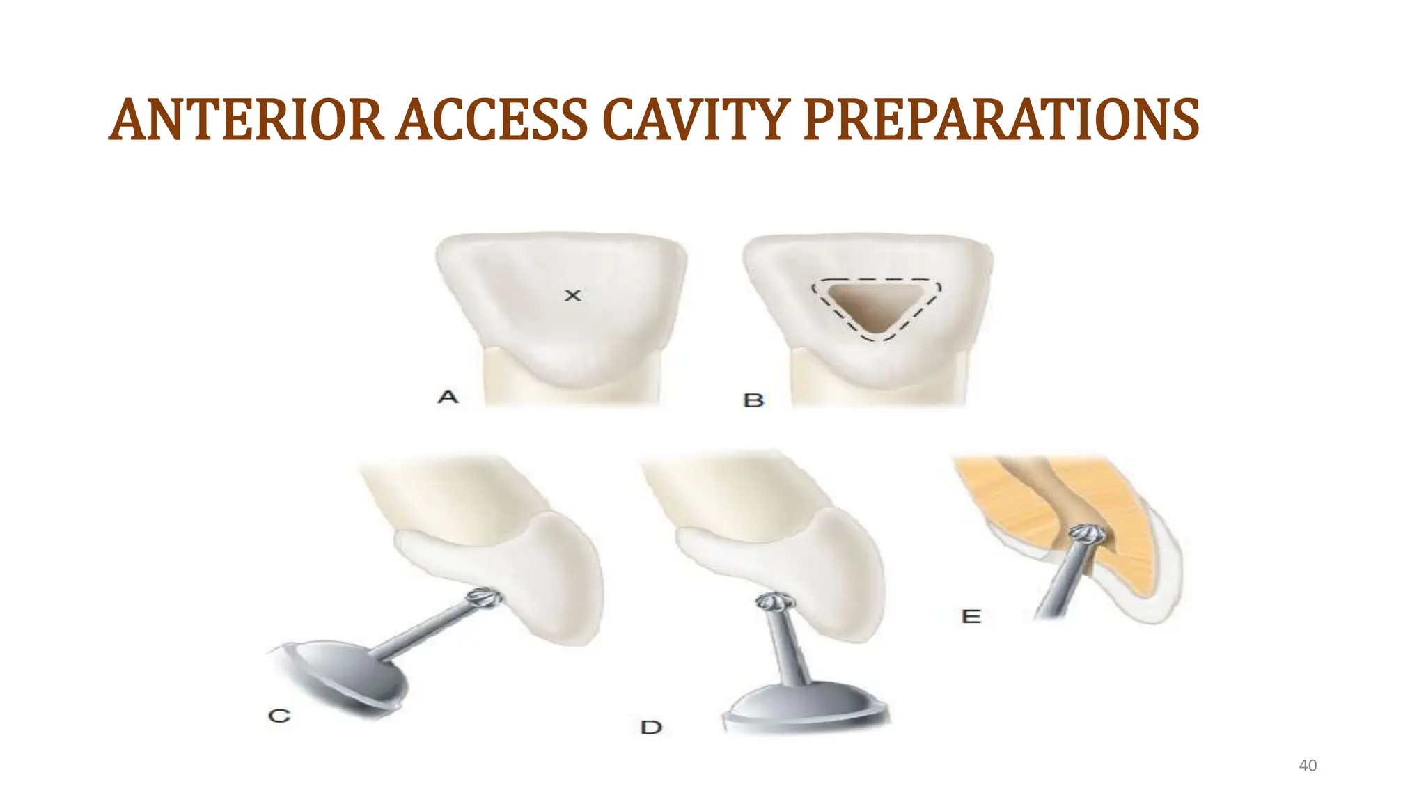 S11 endodontic ACCESS_CAVITY_PREPARATION.pptx