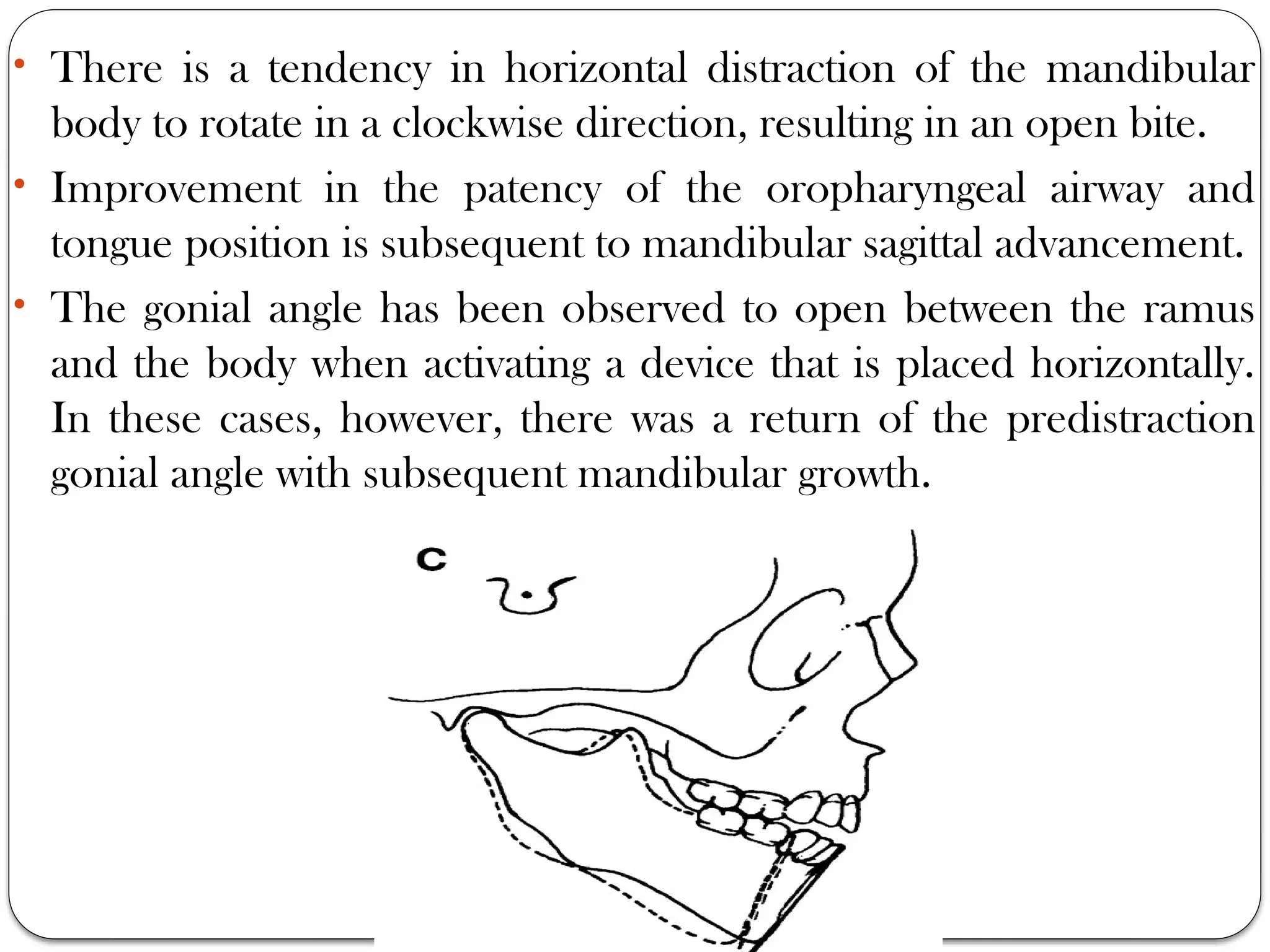 distraction osteogenesis in orthodontics | PPTX