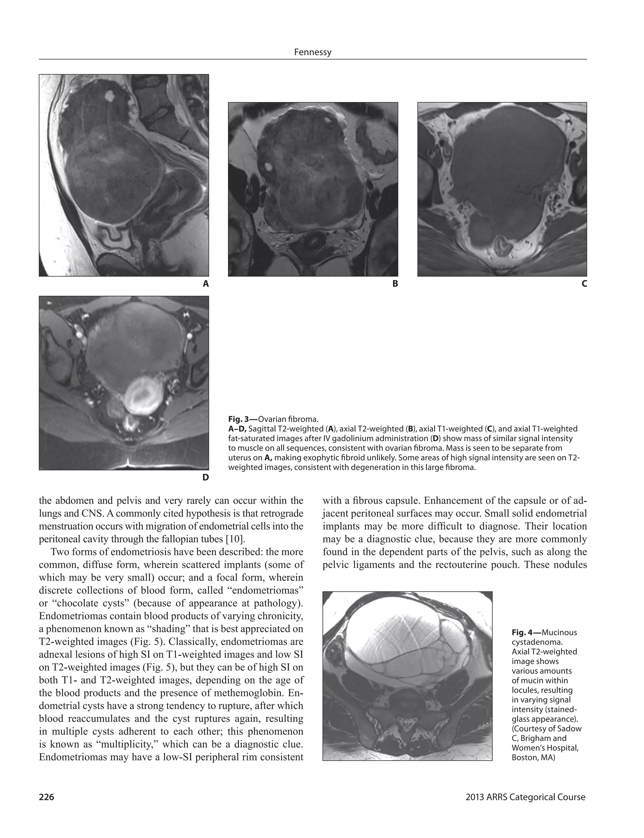 MRI of Benign Female Pelvis | PDF