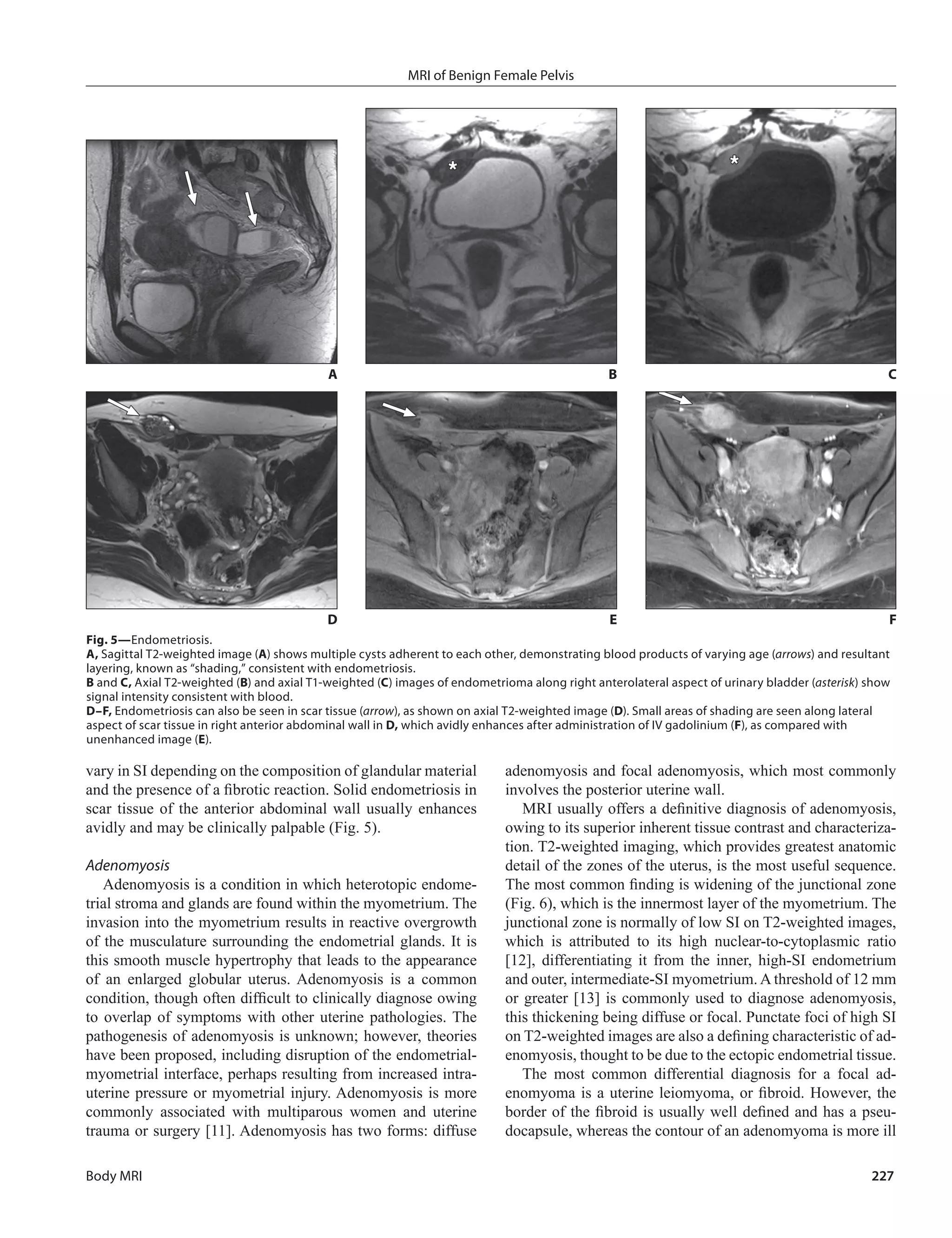 MRI of Benign Female Pelvis | PDF