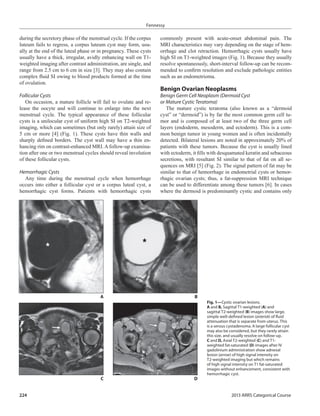 MRI of Benign Female Pelvis | PDF