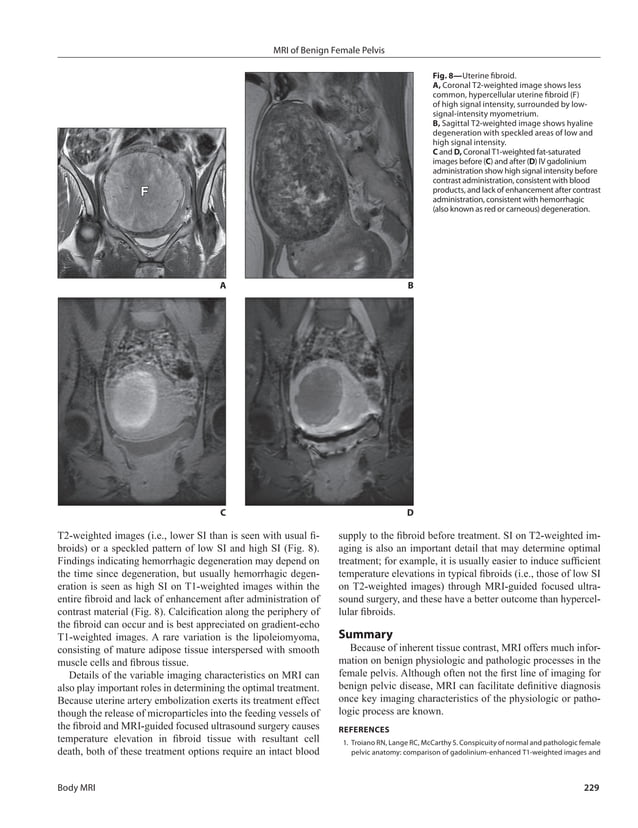 MRI of Benign Female Pelvis | PDF