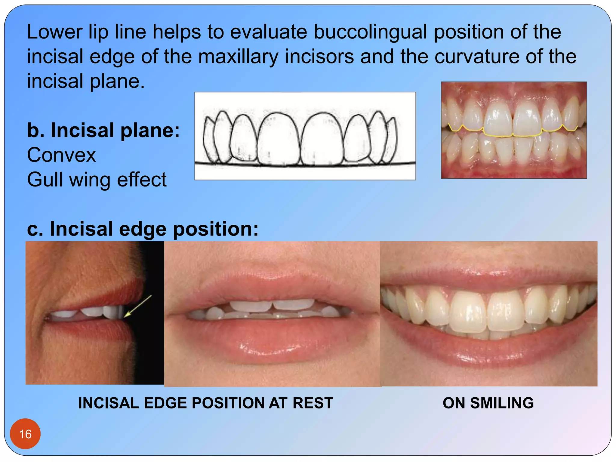 Esthetics in FPD | PPTX