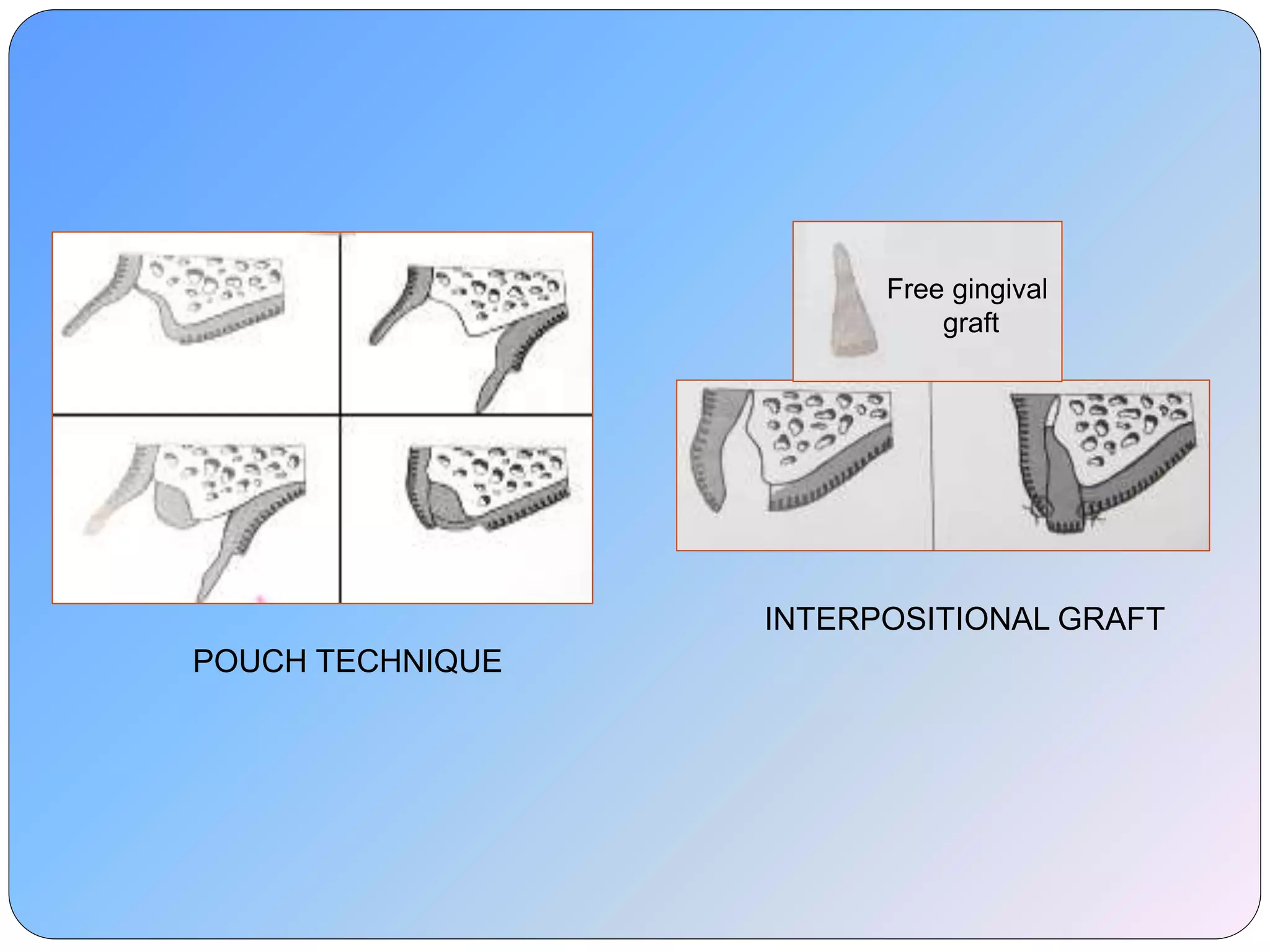 Esthetics in FPD | PPTX