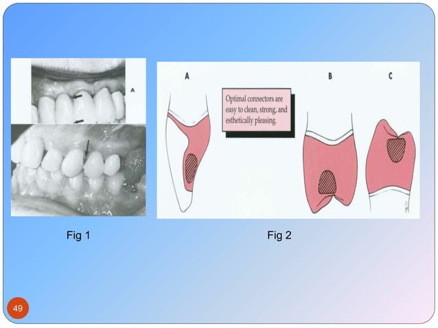 Esthetics in FPD | PPTX | Dental Health | Diseases and Conditions