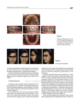 S2395921516301714.pdf anterior open bite | PDF