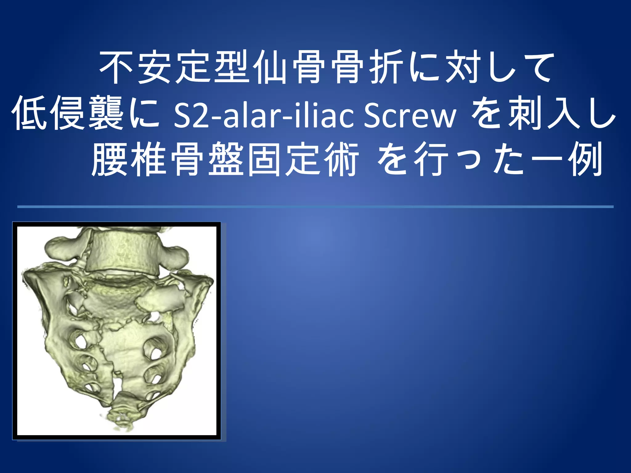 【地方会】S2AI screw による腰椎骨盤固定術 | PPT