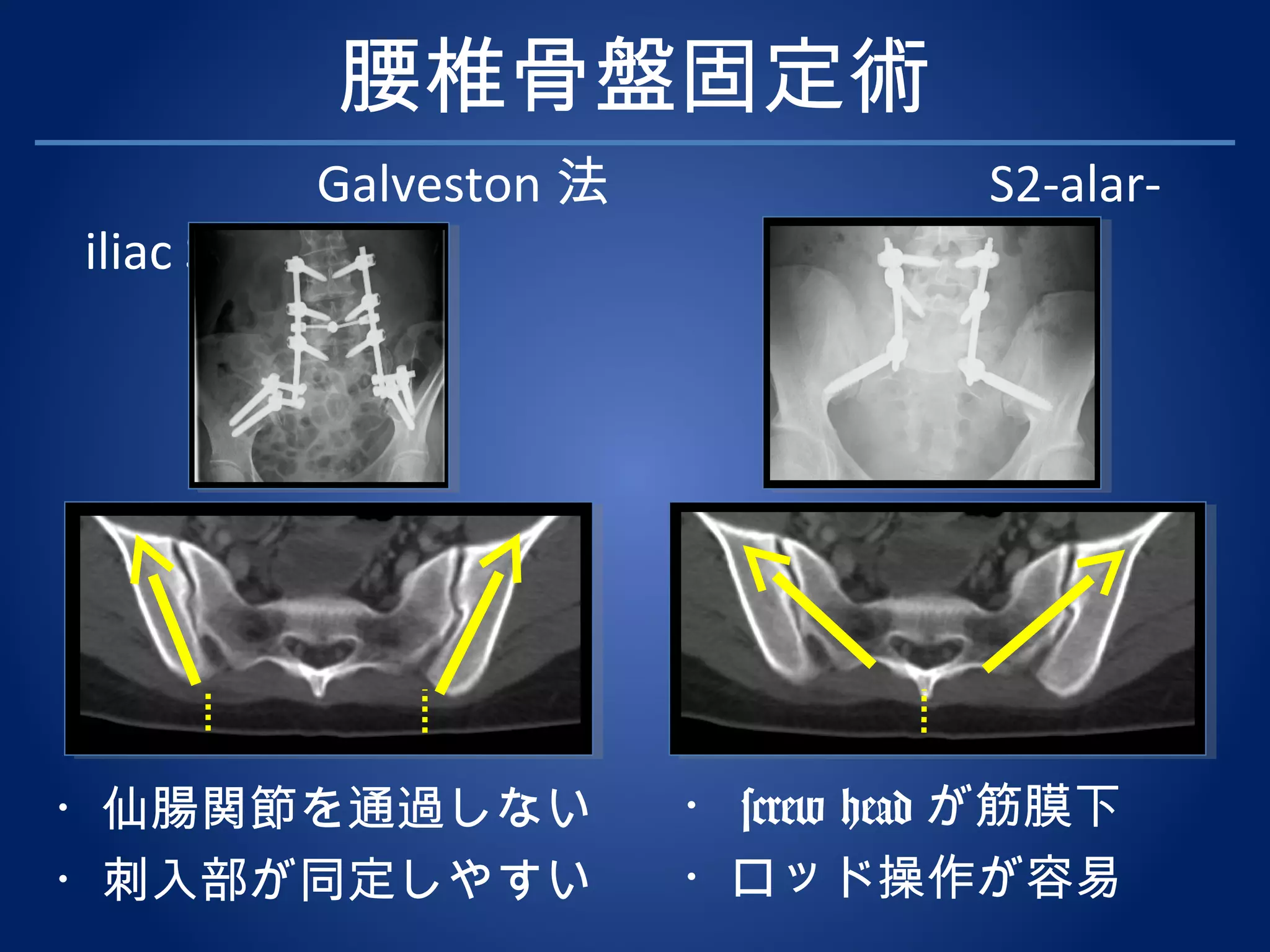 【地方会】S2AI screw による腰椎骨盤固定術 | PPT