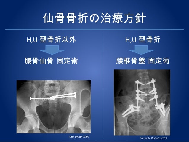 【地方会】S2AI screw による腰椎骨盤固定術
