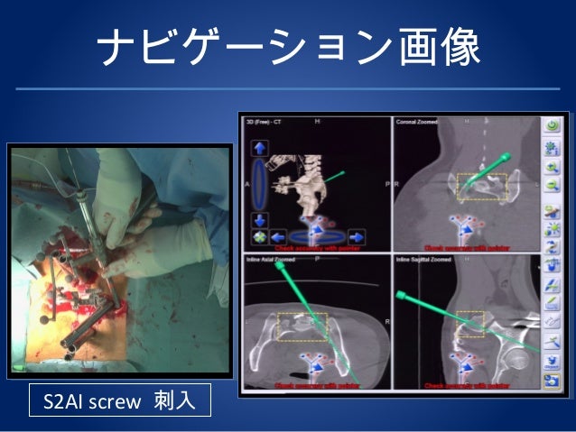 【地方会】S2AI screw による腰椎骨盤固定術