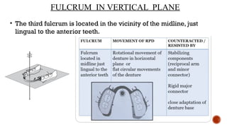 Biomechanical principles in removable partial dentures (rpd) | PPTX