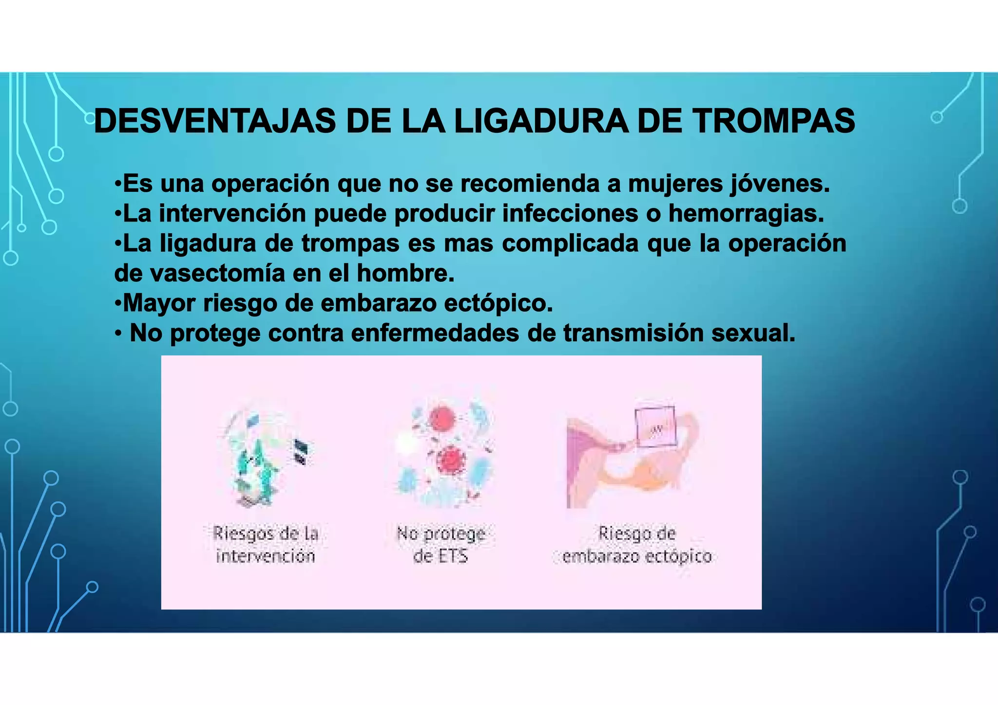 S3- MÉTODOS ANTICONCEPTIVOS DEFINITIVOS- LIGADURA DE TROMPAS.pdf