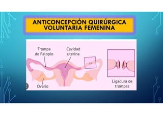 S3- MÉTODOS ANTICONCEPTIVOS DEFINITIVOS- LIGADURA DE TROMPAS.pdf