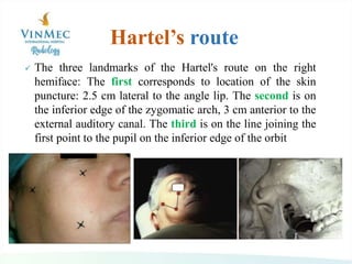 Phong bế hạch Gasserian | PPTX