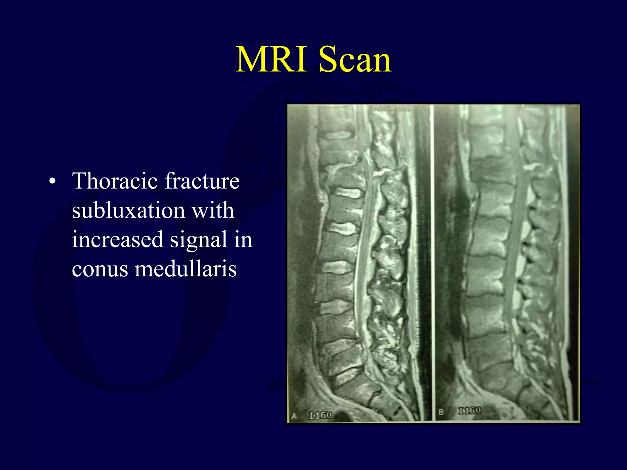 S4_Classification-Thoracolumar-Spine.ppt