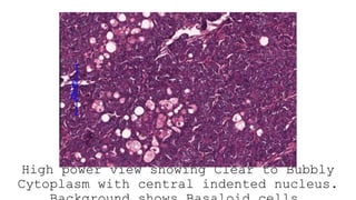 S5 KCIAPM June sebaceous adenoma case.pptx