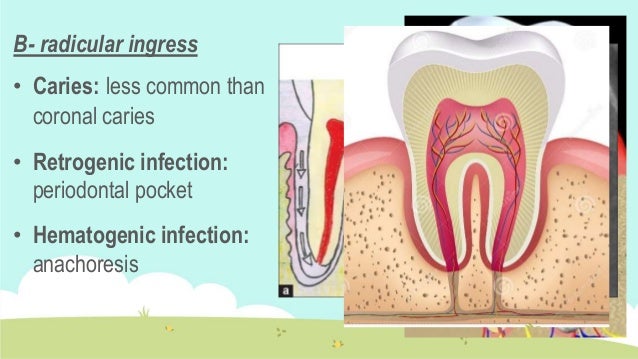 Etiology of pulp diseases