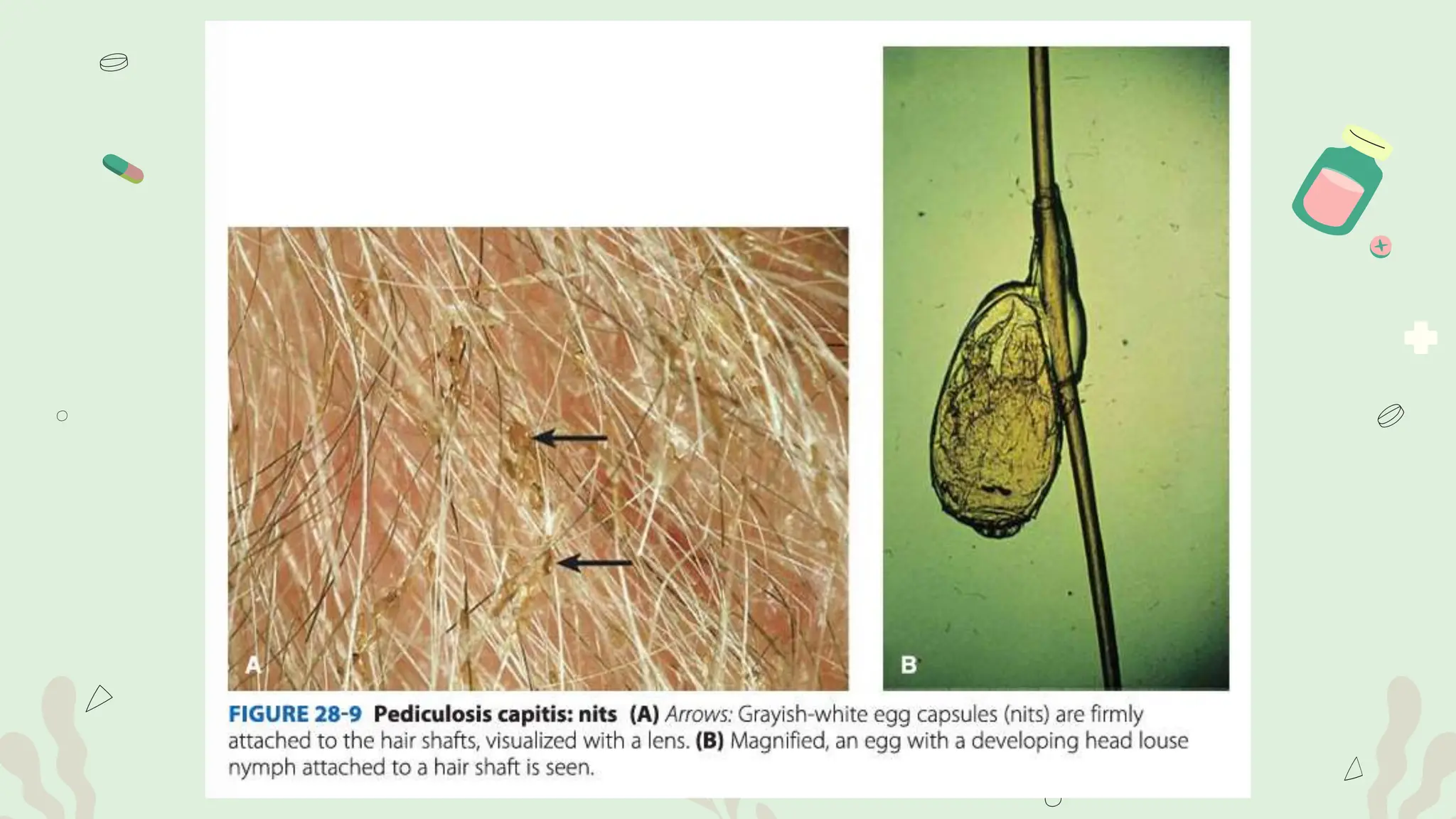 Scabies & Parasitic Infestations (Impetigo) | PPTX