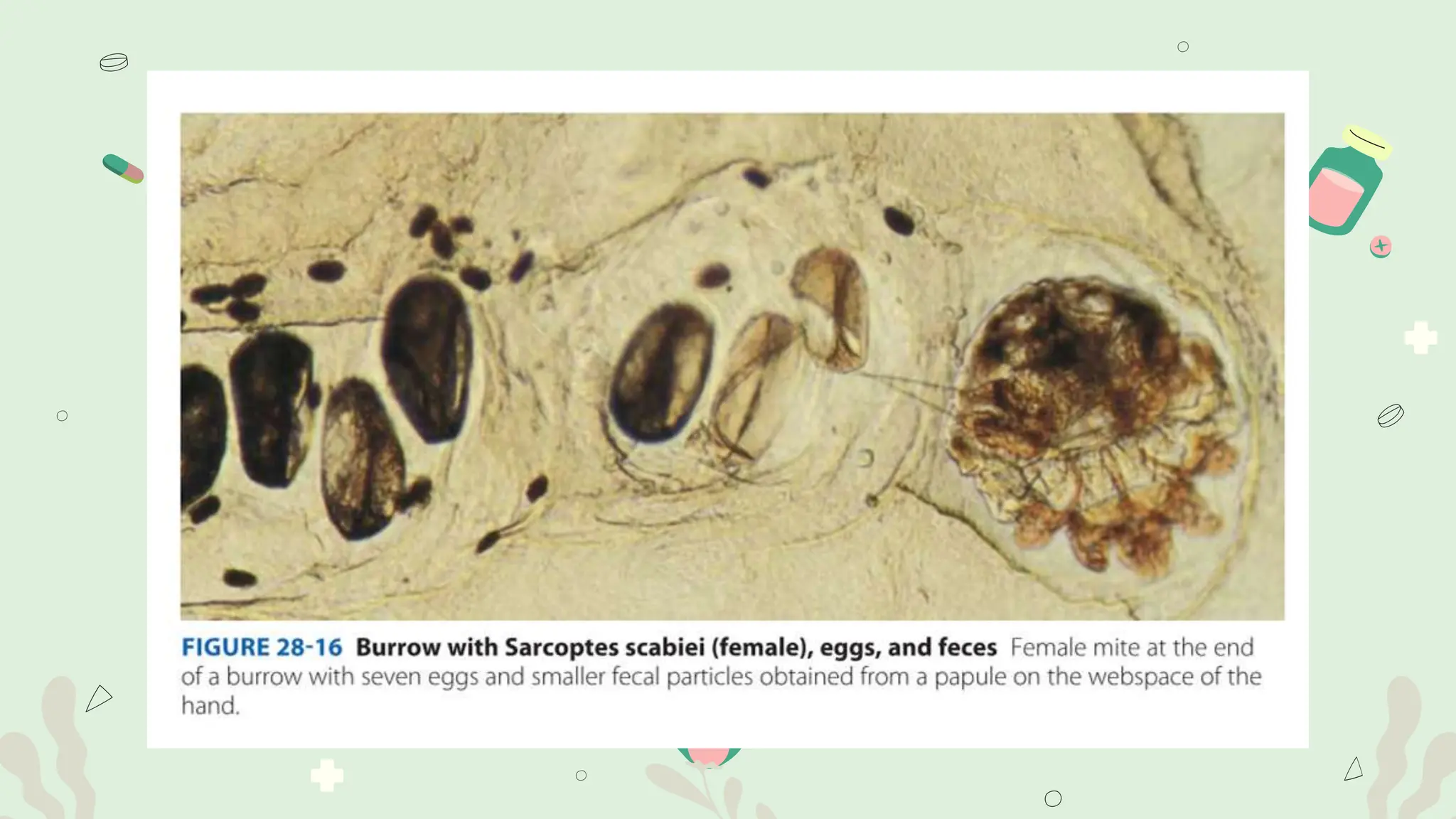 Scabies & Parasitic Infestations (Impetigo) | PPTX
