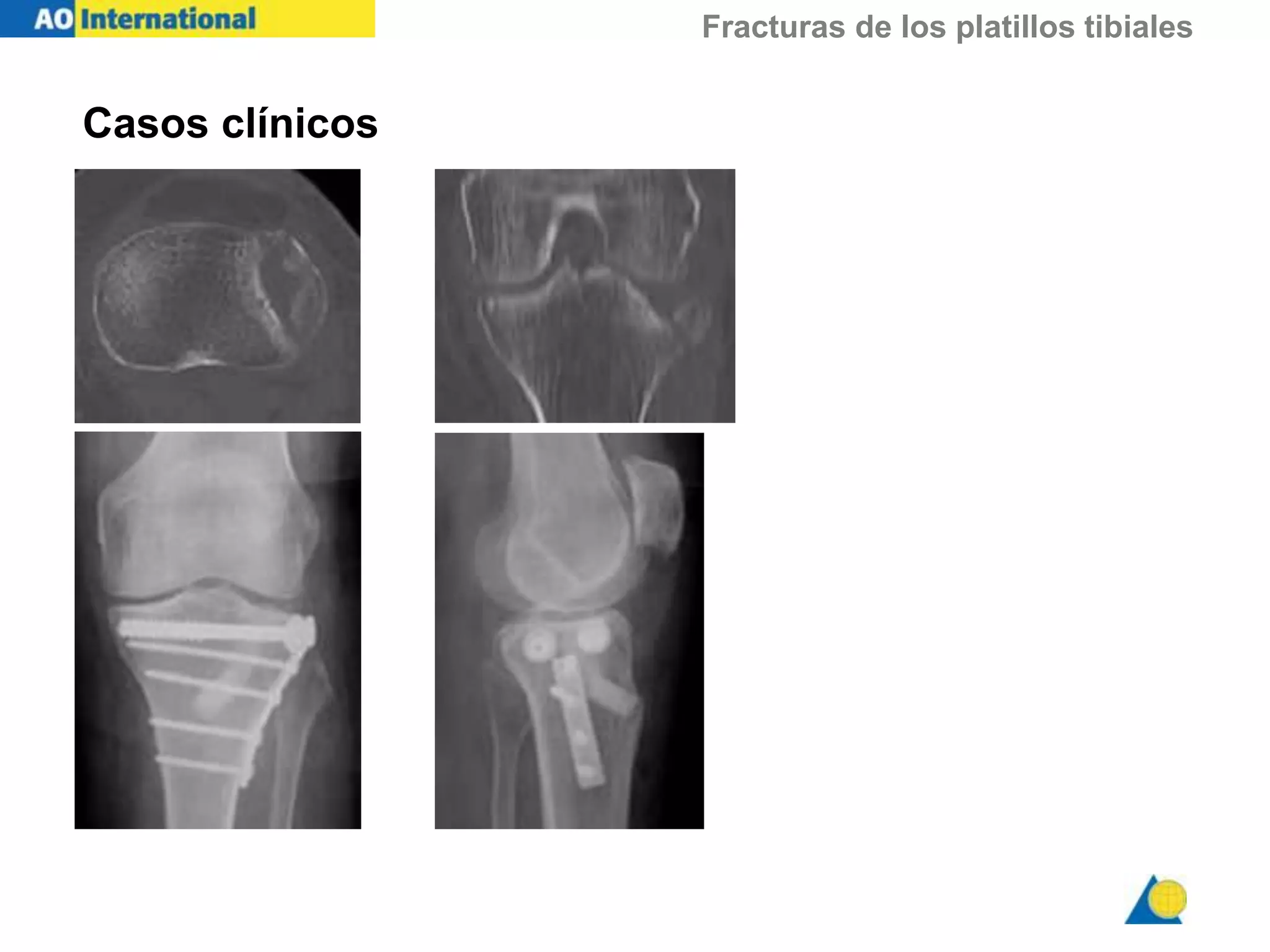 Fracturas del platillo tibial | PDF