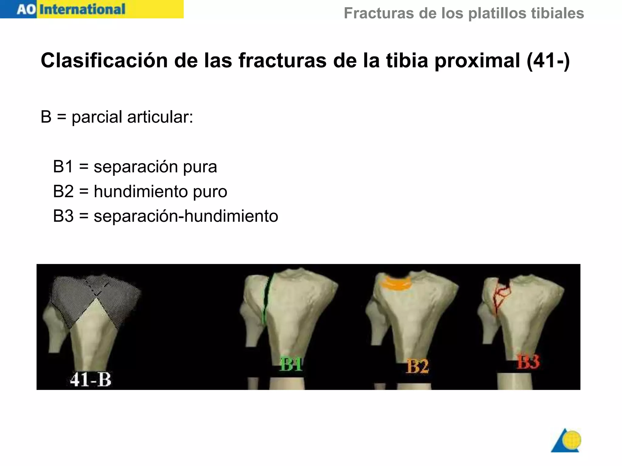 Fracturas del platillo tibial | PDF