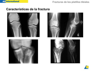 Fracturas del platillo tibial | PDF