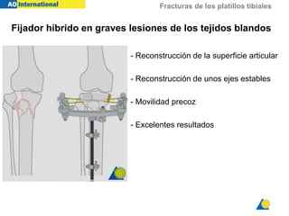 Fracturas del platillo tibial | PDF
