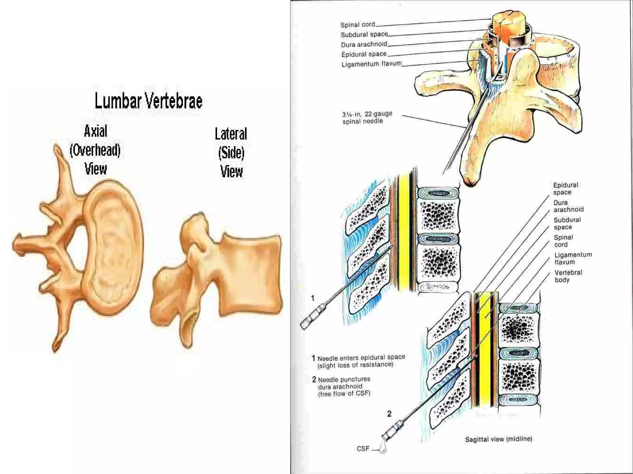 SPINAL ANAESTHESIA | PPT