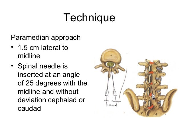 SPINAL ANAESTHESIA