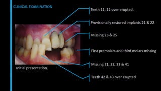 Implant case presentation | PPTX