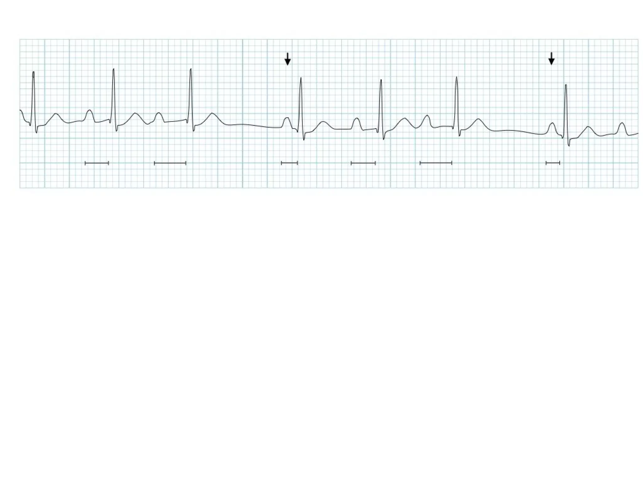 ECG Lecture: Sinus arrest, sinoatrial exit block, AV block and escape ...