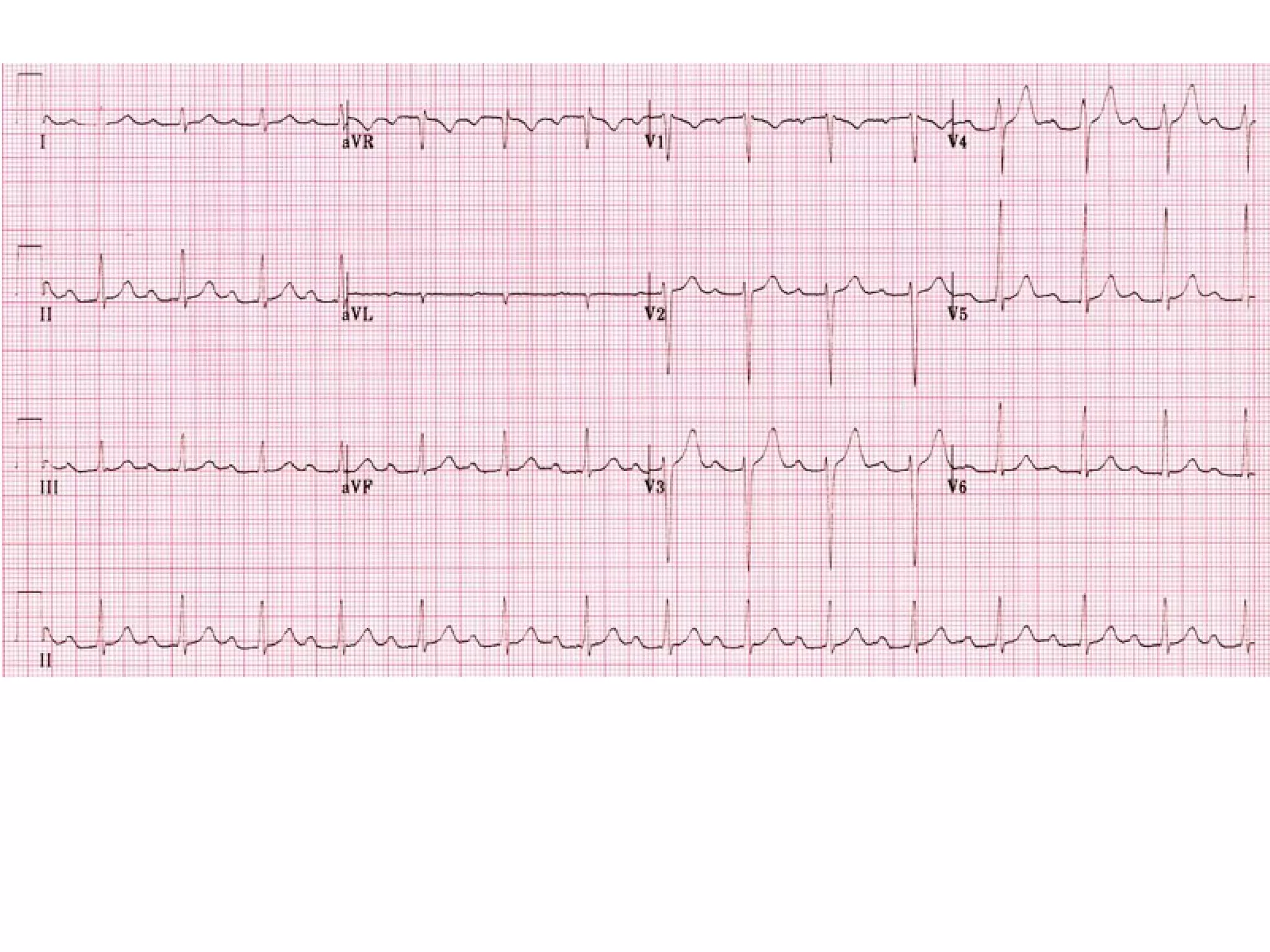 ECG Lecture: Sinus arrest, sinoatrial exit block, AV block and escape ...