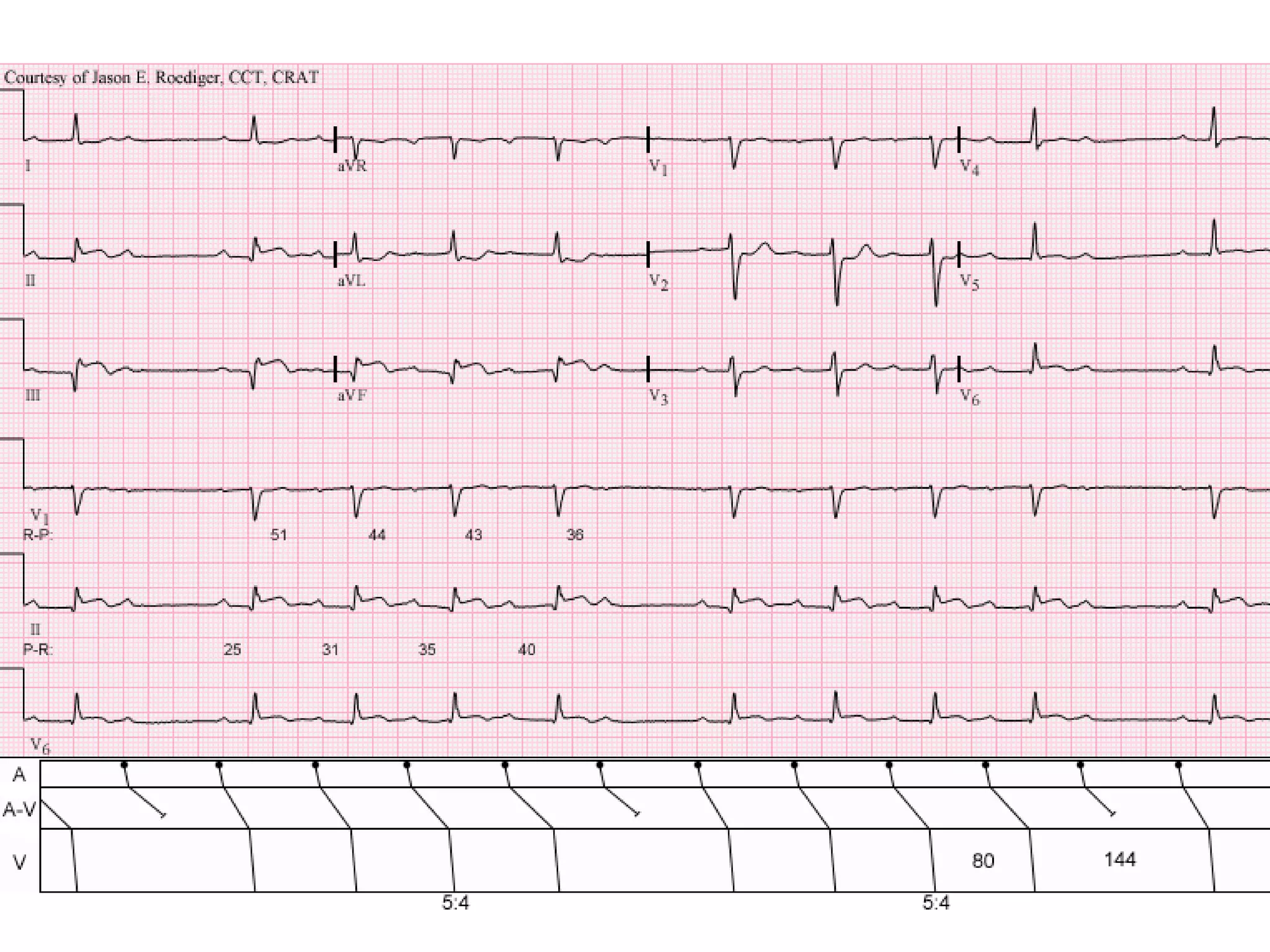ECG Lecture: Sinus arrest, sinoatrial exit block, AV block and escape ...