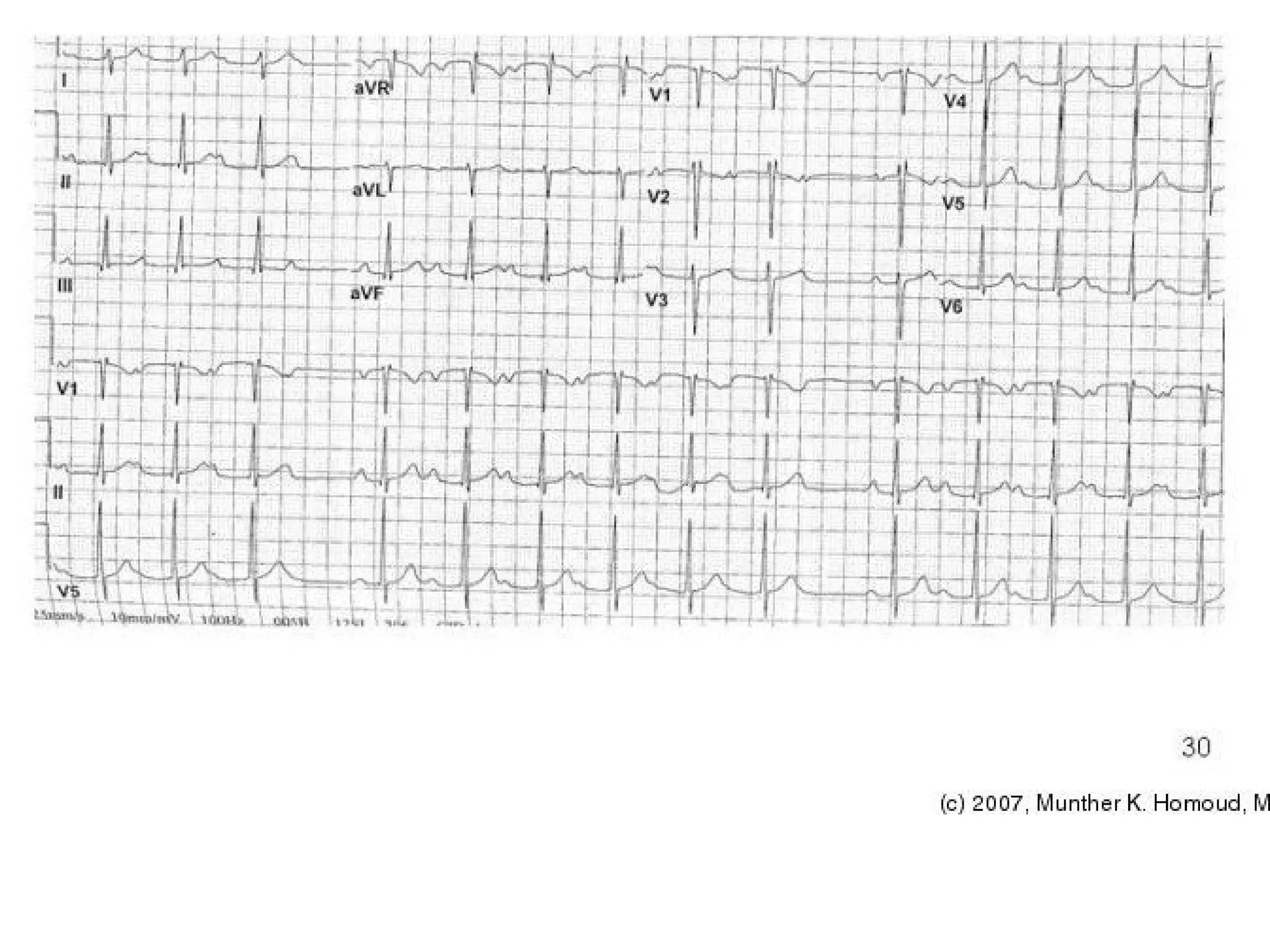 ECG Lecture: Sinus arrest, sinoatrial exit block, AV block and escape ...