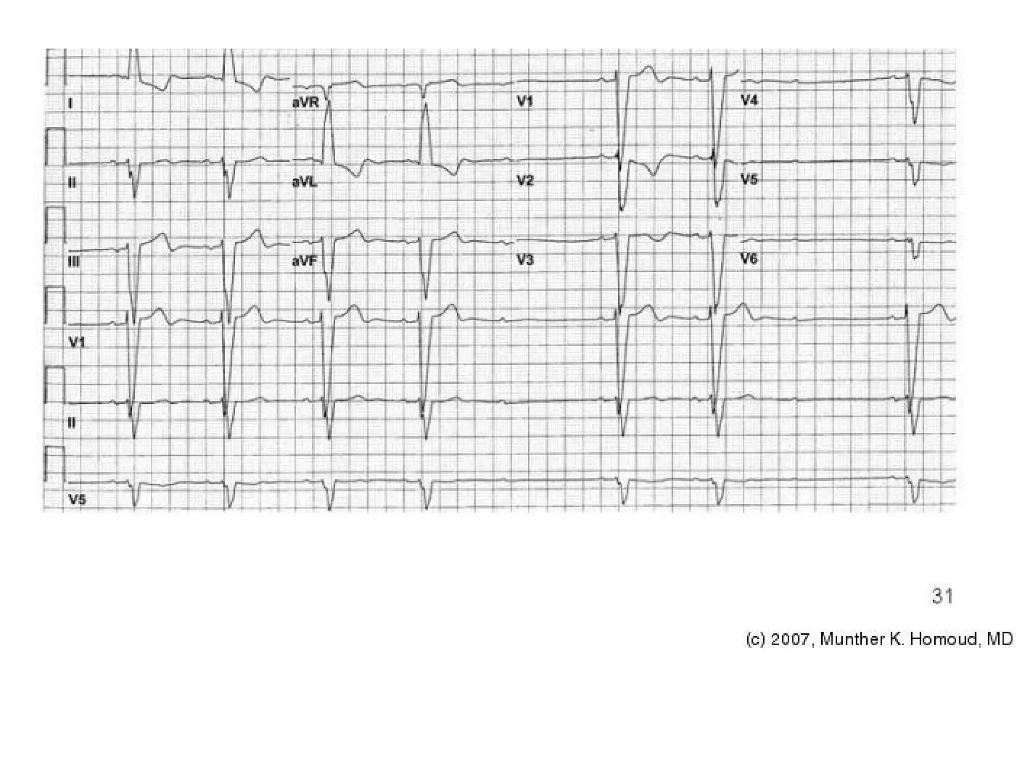 ECG Lecture: Sinus arrest, sinoatrial exit block, AV block and escape ...
