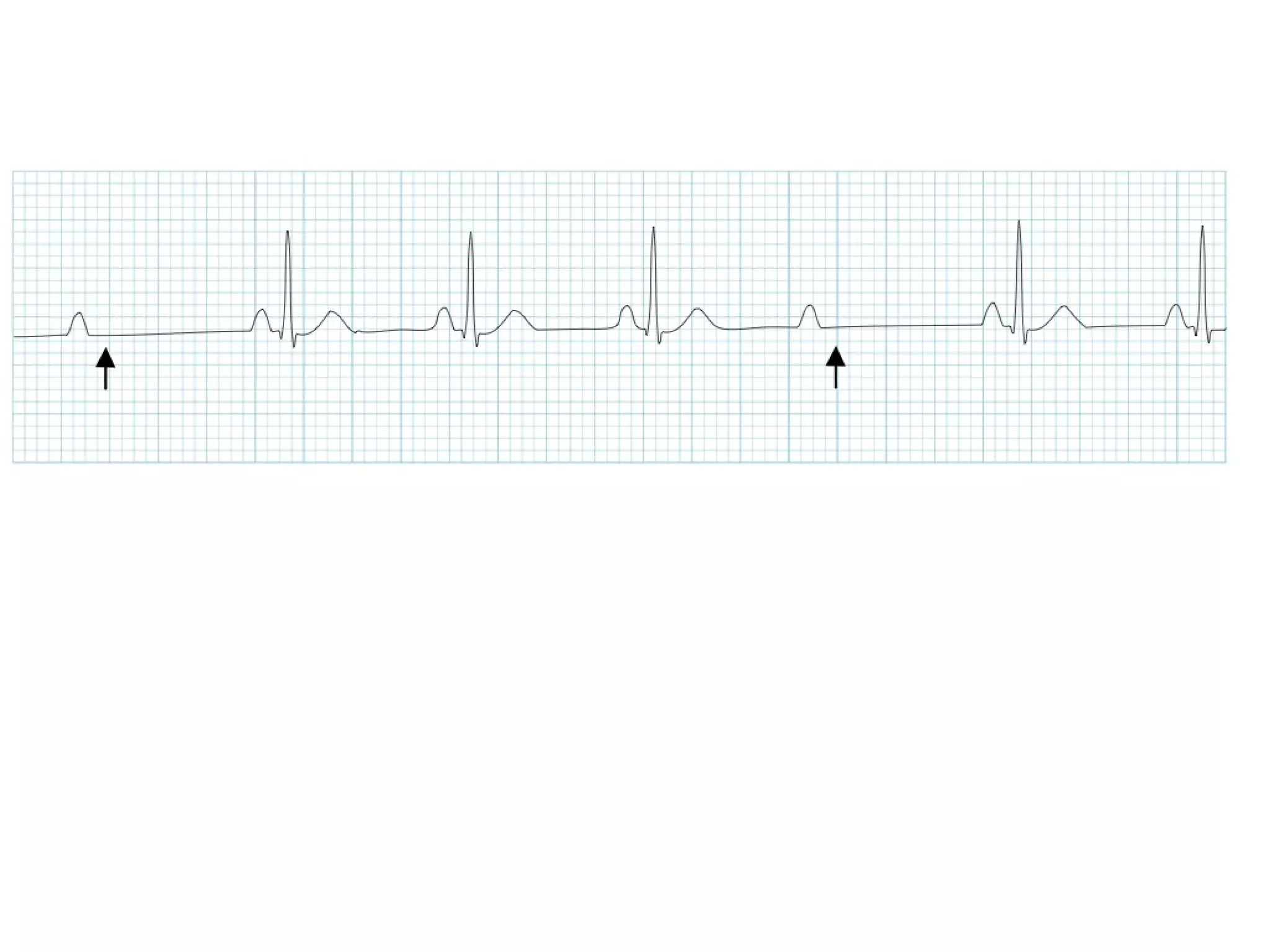 ECG Lecture: Sinus arrest, sinoatrial exit block, AV block and escape ...