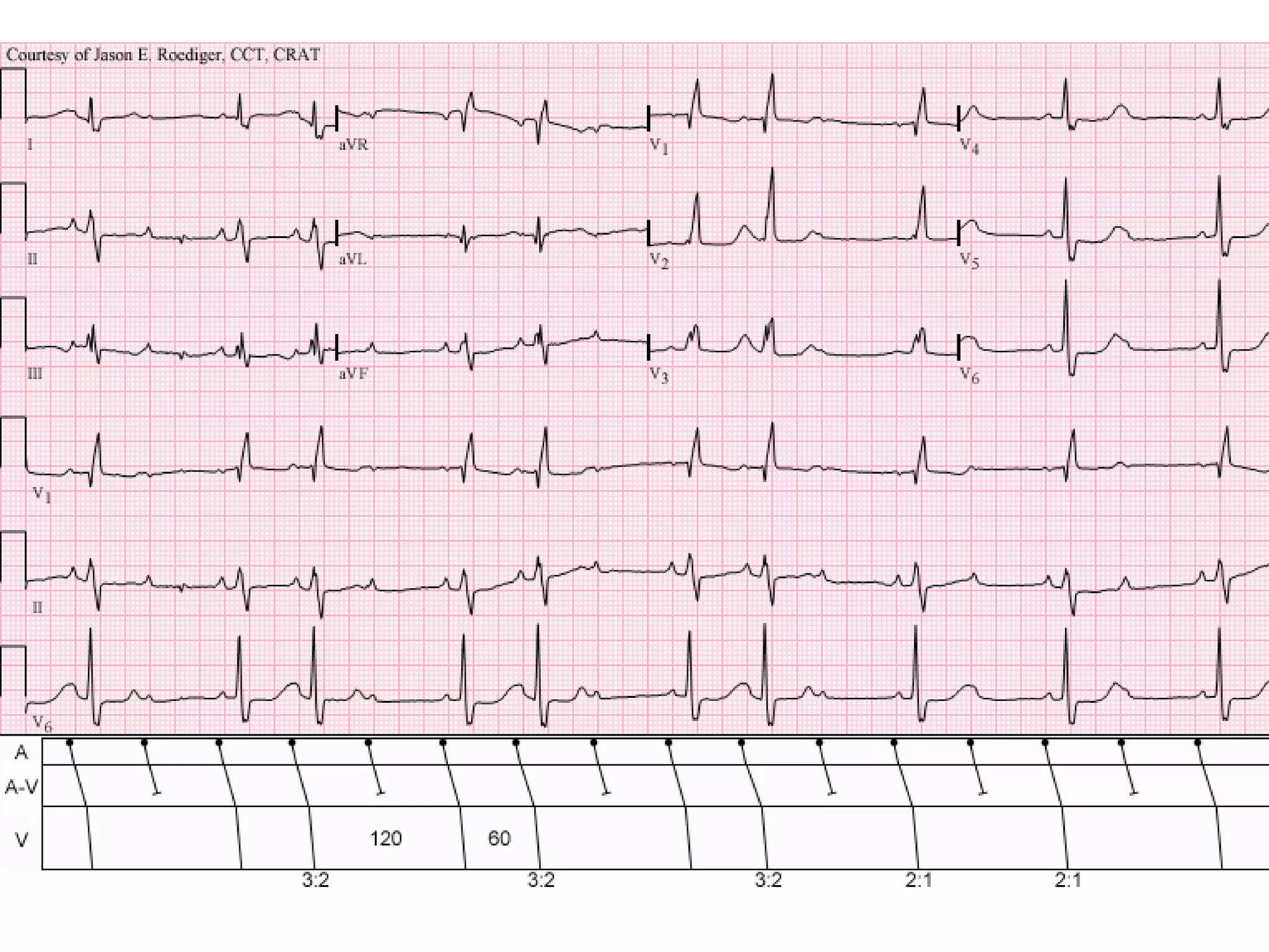 ECG Lecture: Sinus arrest, sinoatrial exit block, AV block and escape ...