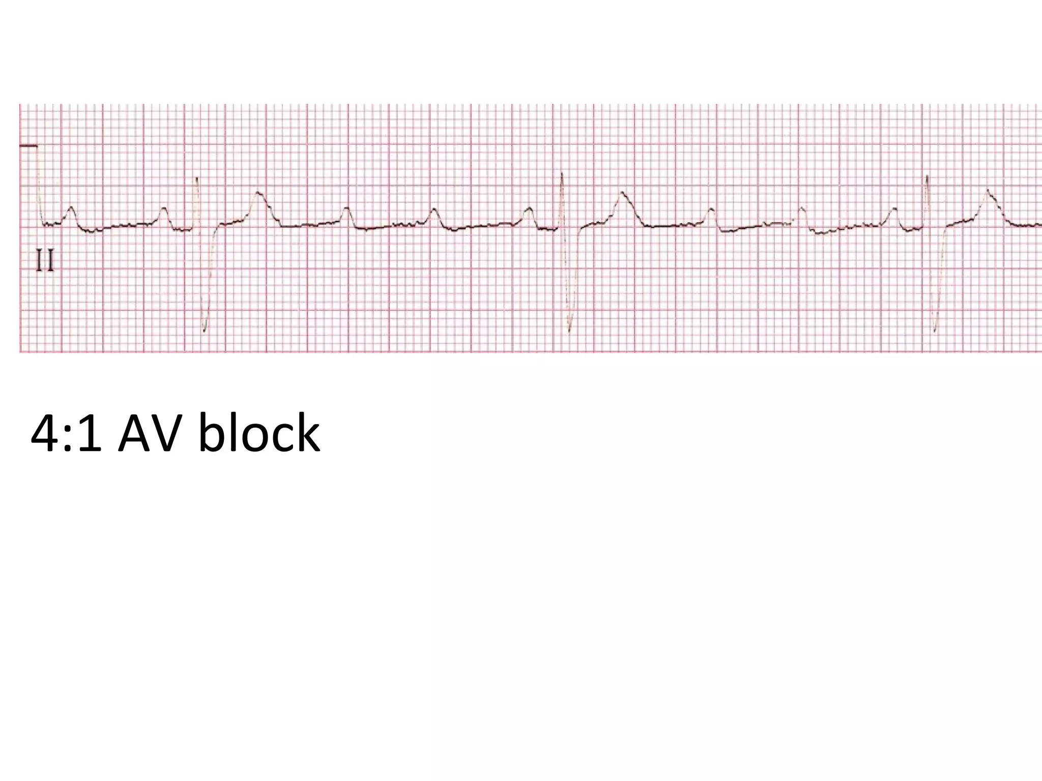 ECG Lecture: Sinus arrest, sinoatrial exit block, AV block and escape ...