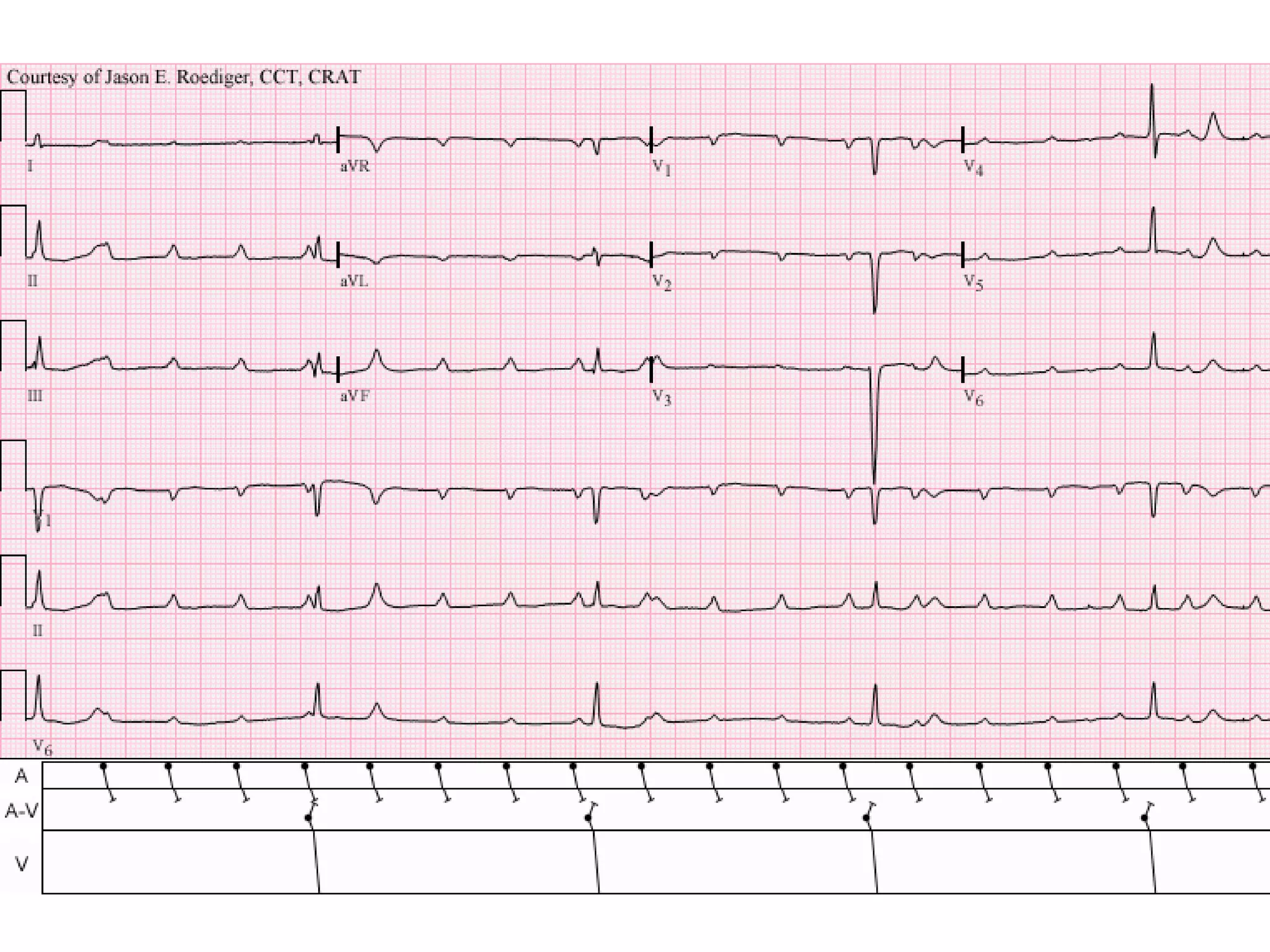 ECG Lecture: Sinus arrest, sinoatrial exit block, AV block and escape ...