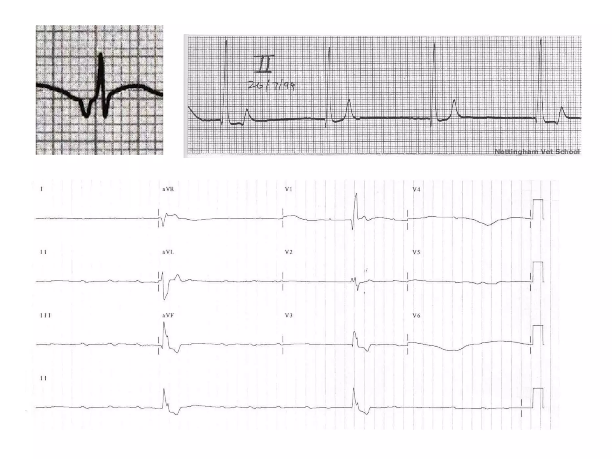 ECG Lecture: Sinus arrest, sinoatrial exit block, AV block and escape ...
