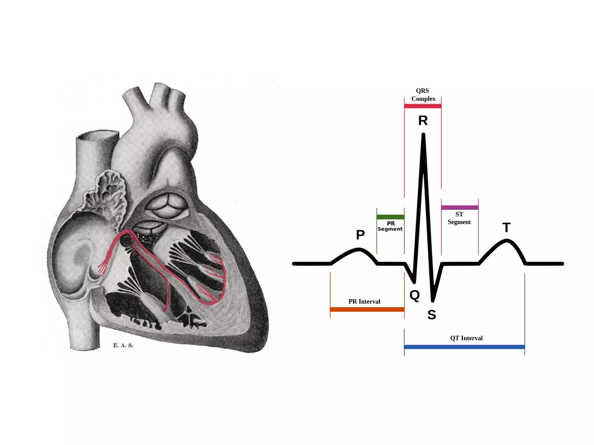 ECG Lecture: Sinus arrest, sinoatrial exit block, AV block and escape ...