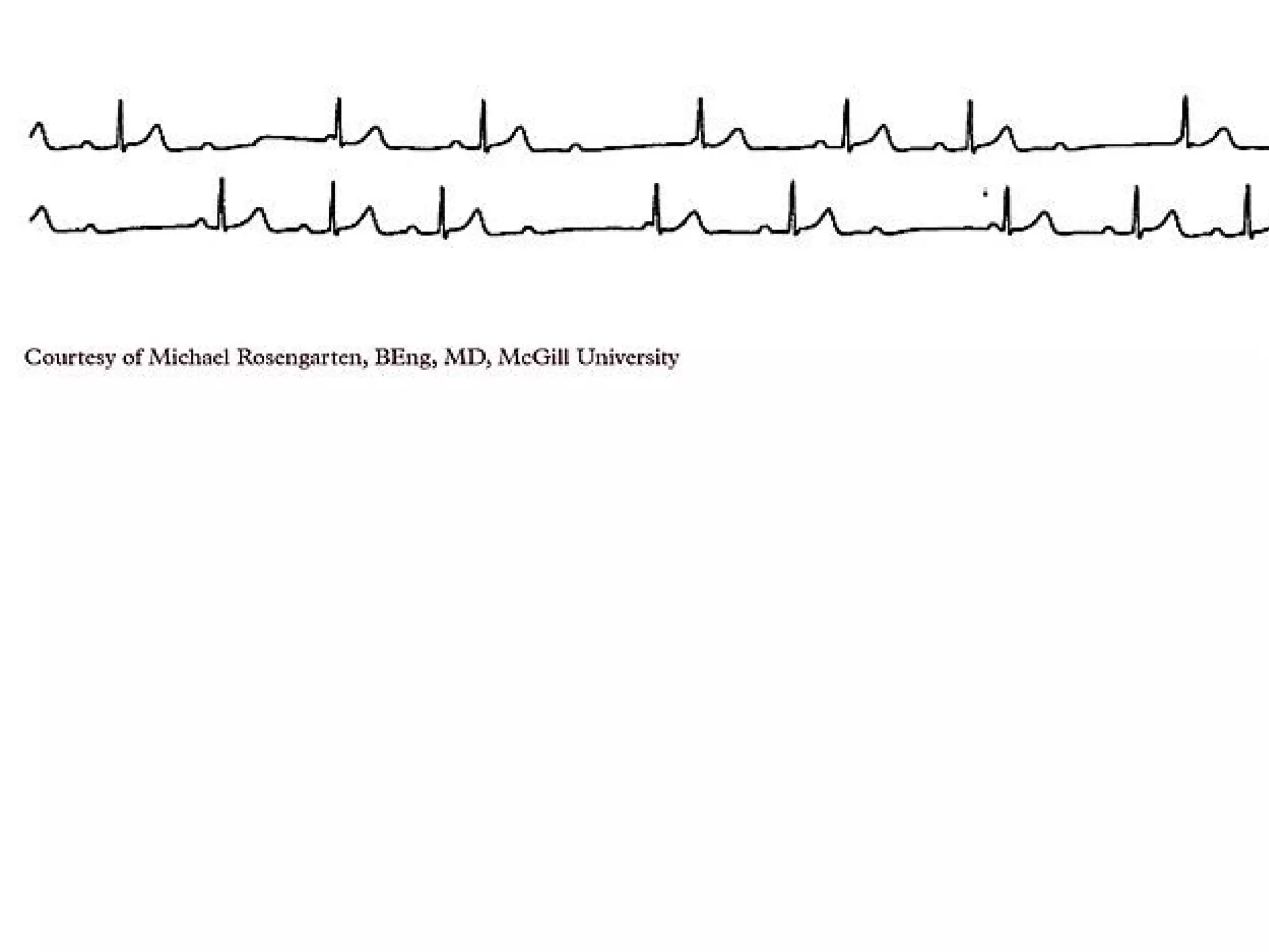 ECG Lecture: Sinus arrest, sinoatrial exit block, AV block and escape ...