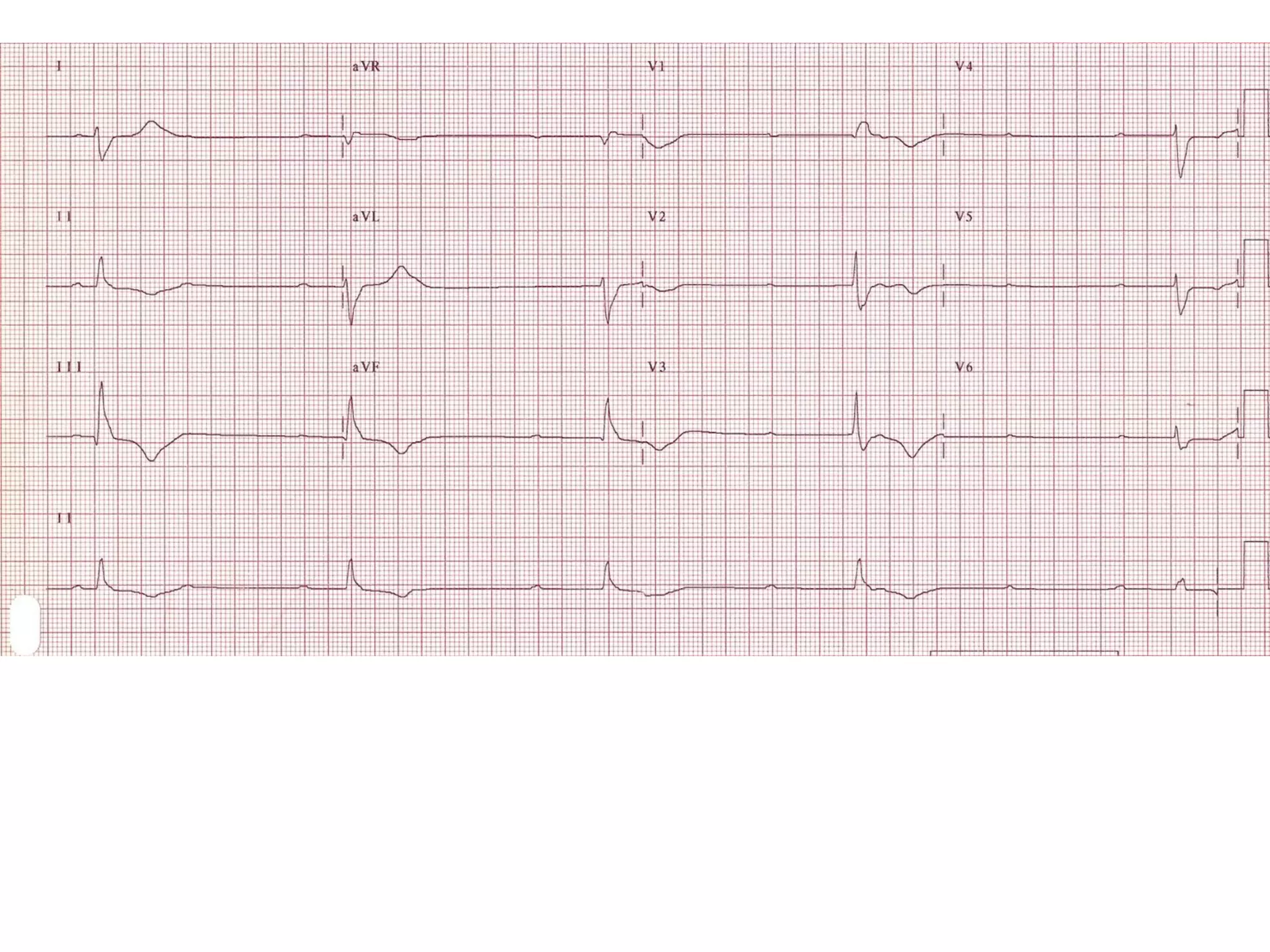 ECG Lecture: Sinus arrest, sinoatrial exit block, AV block and escape ...