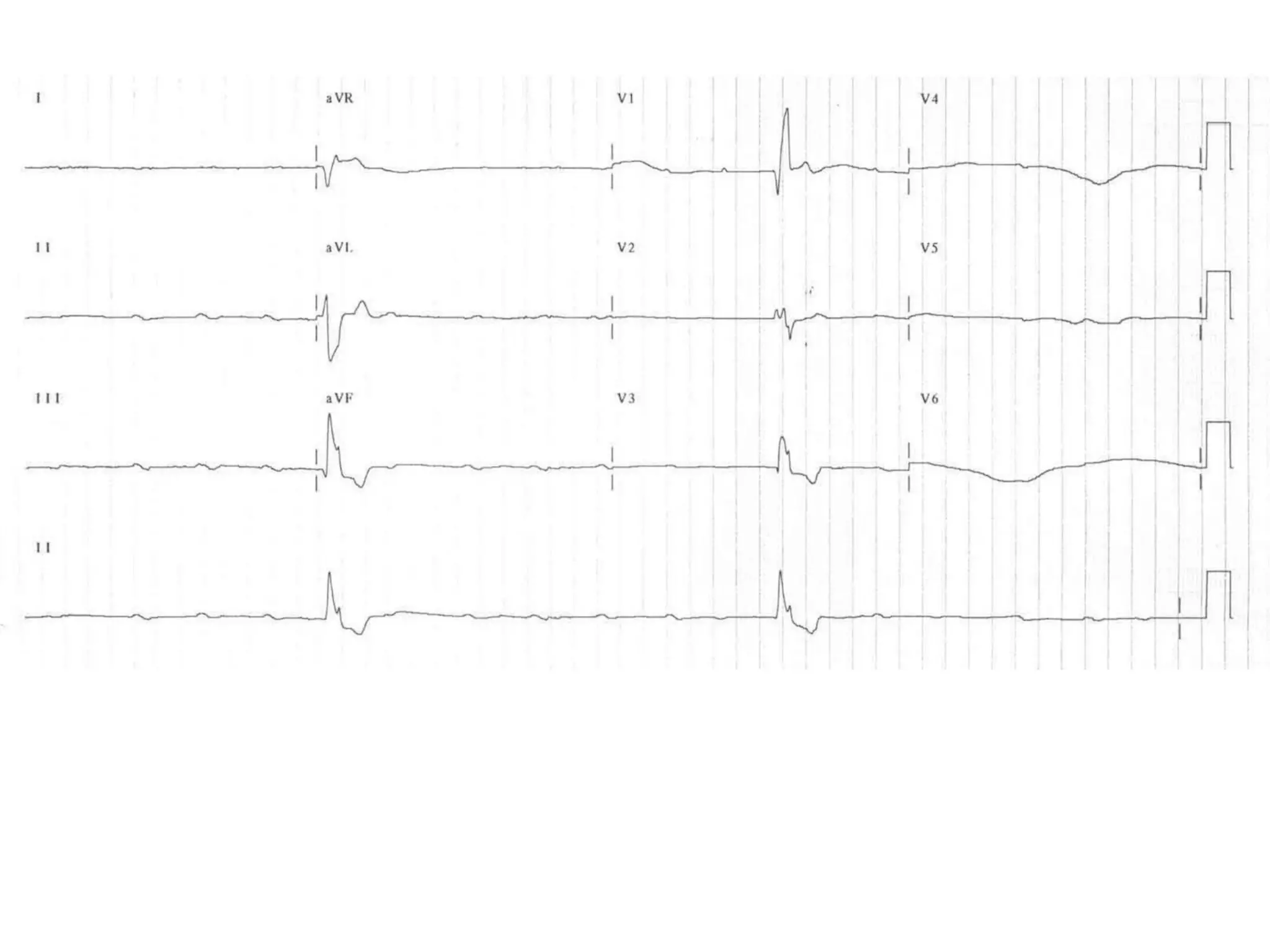 ECG Lecture: Sinus arrest, sinoatrial exit block, AV block and escape ...