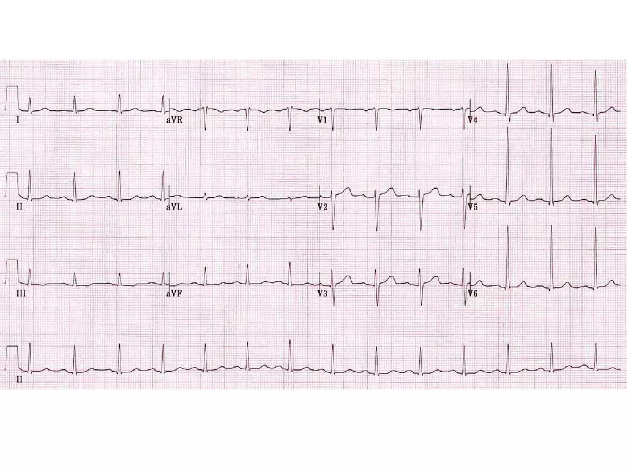 ECG Lecture: Sinus arrest, sinoatrial exit block, AV block and escape ...