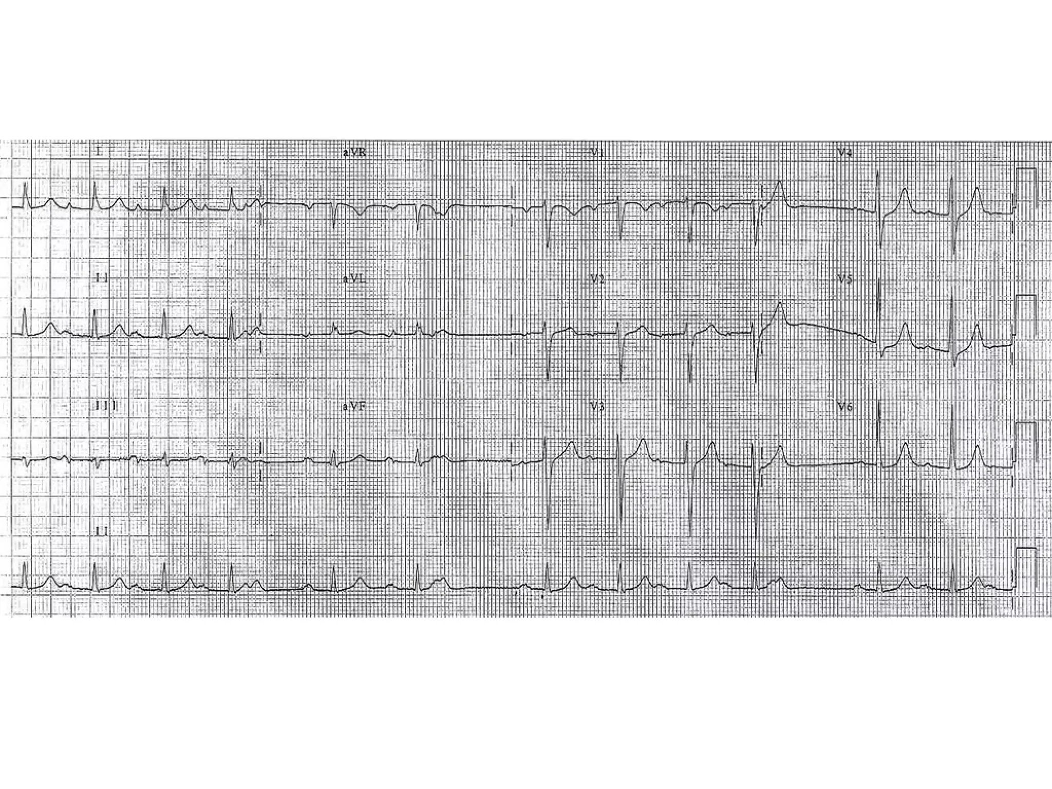 ECG Lecture: Sinus arrest, sinoatrial exit block, AV block and escape ...