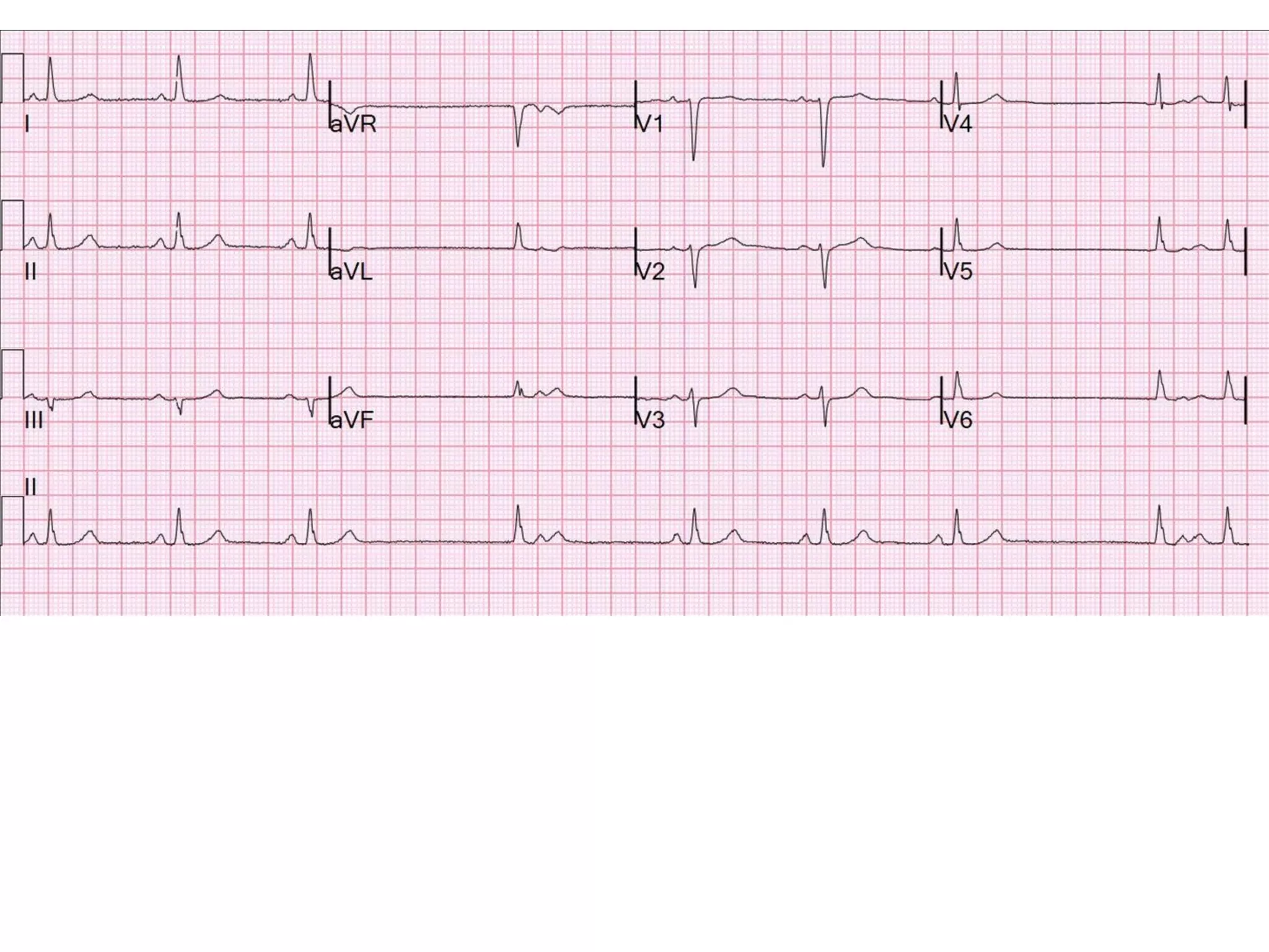 ECG Lecture: Sinus arrest, sinoatrial exit block, AV block and escape ...