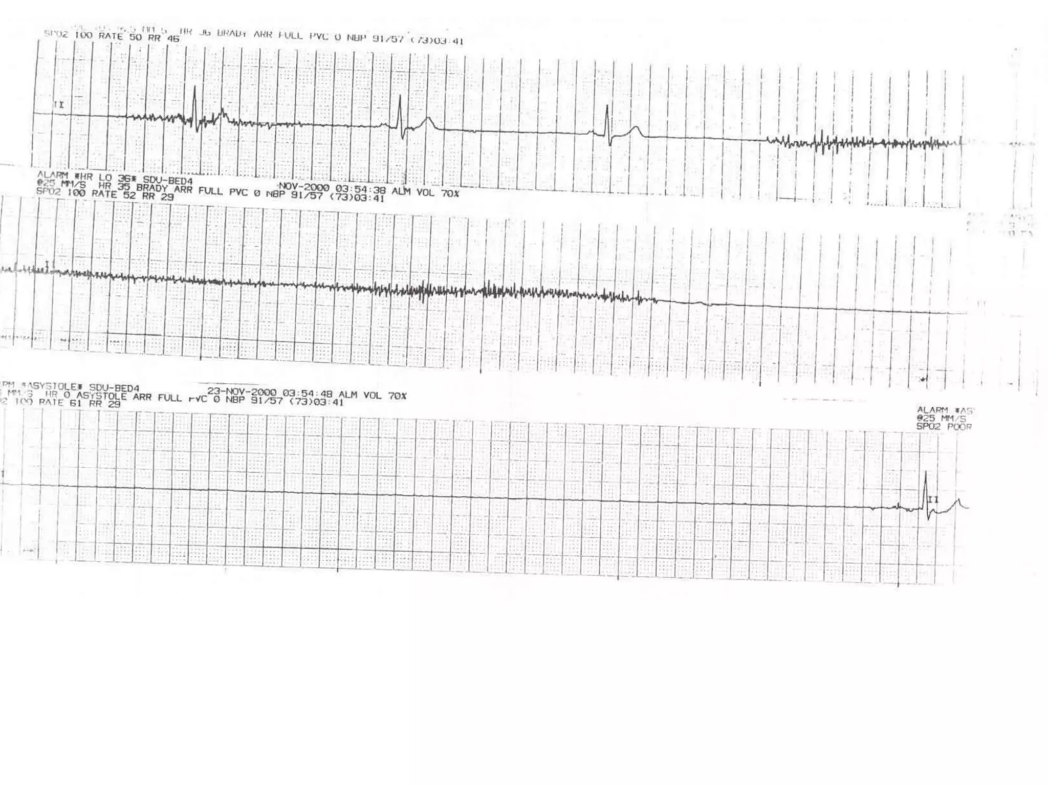 ECG Lecture: Sinus arrest, sinoatrial exit block, AV block and escape ...