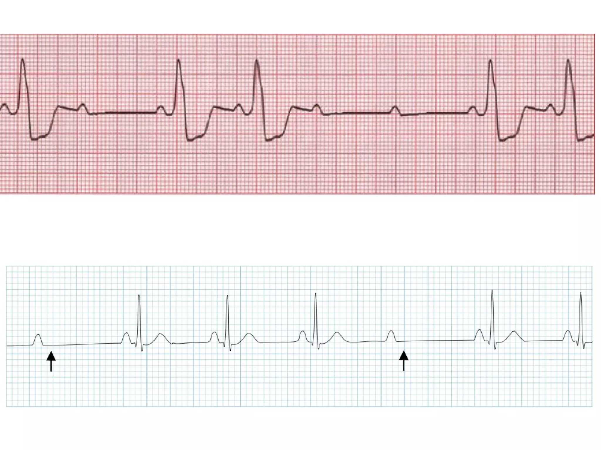 ECG Lecture: Sinus arrest, sinoatrial exit block, AV block and escape ...