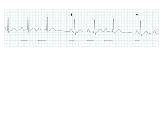ECG Lecture: Sinus arrest, sinoatrial exit block, AV block and escape ...